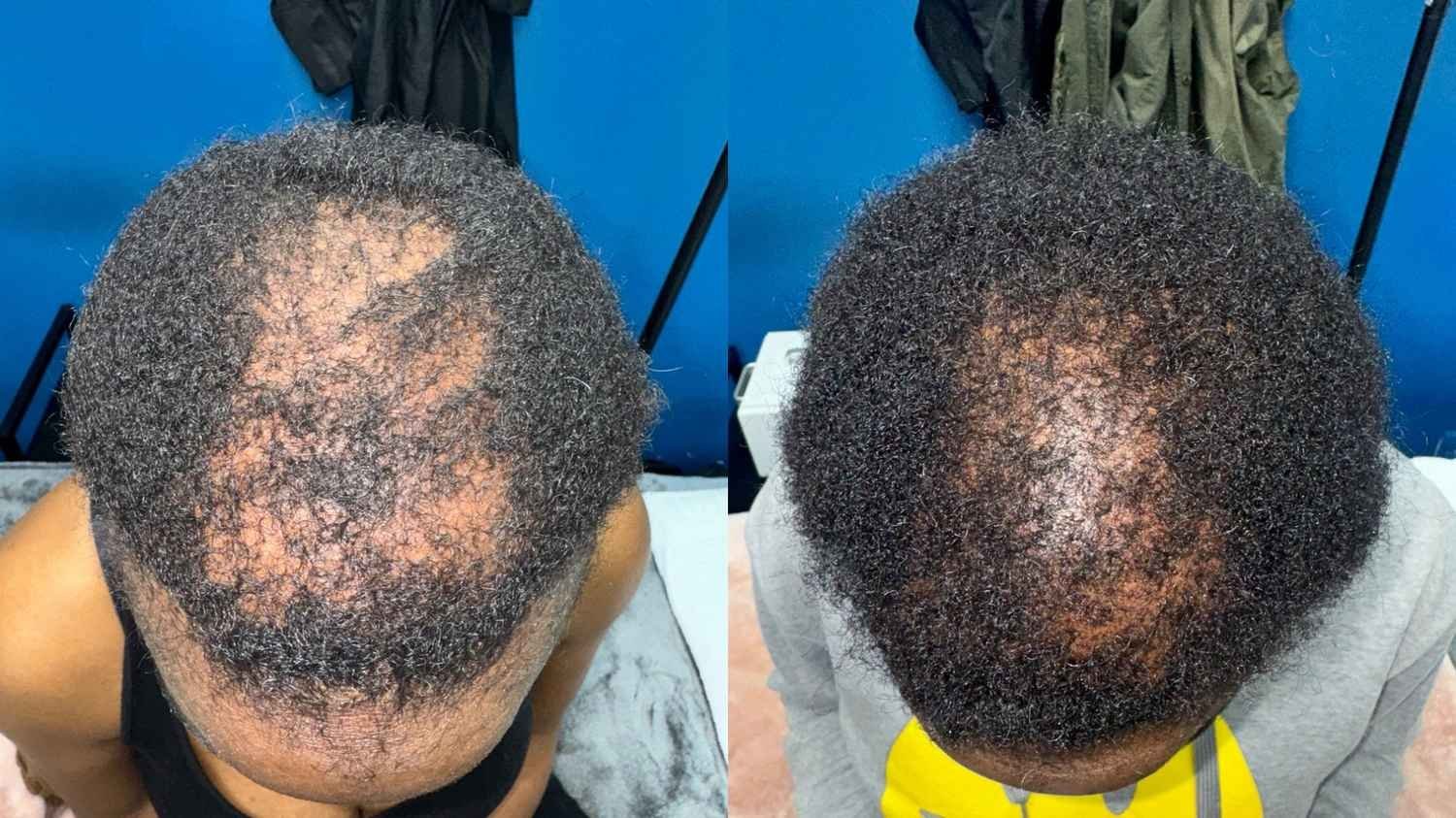 Procell Microchanneling at North Fork Rejuvenation Aesthetics