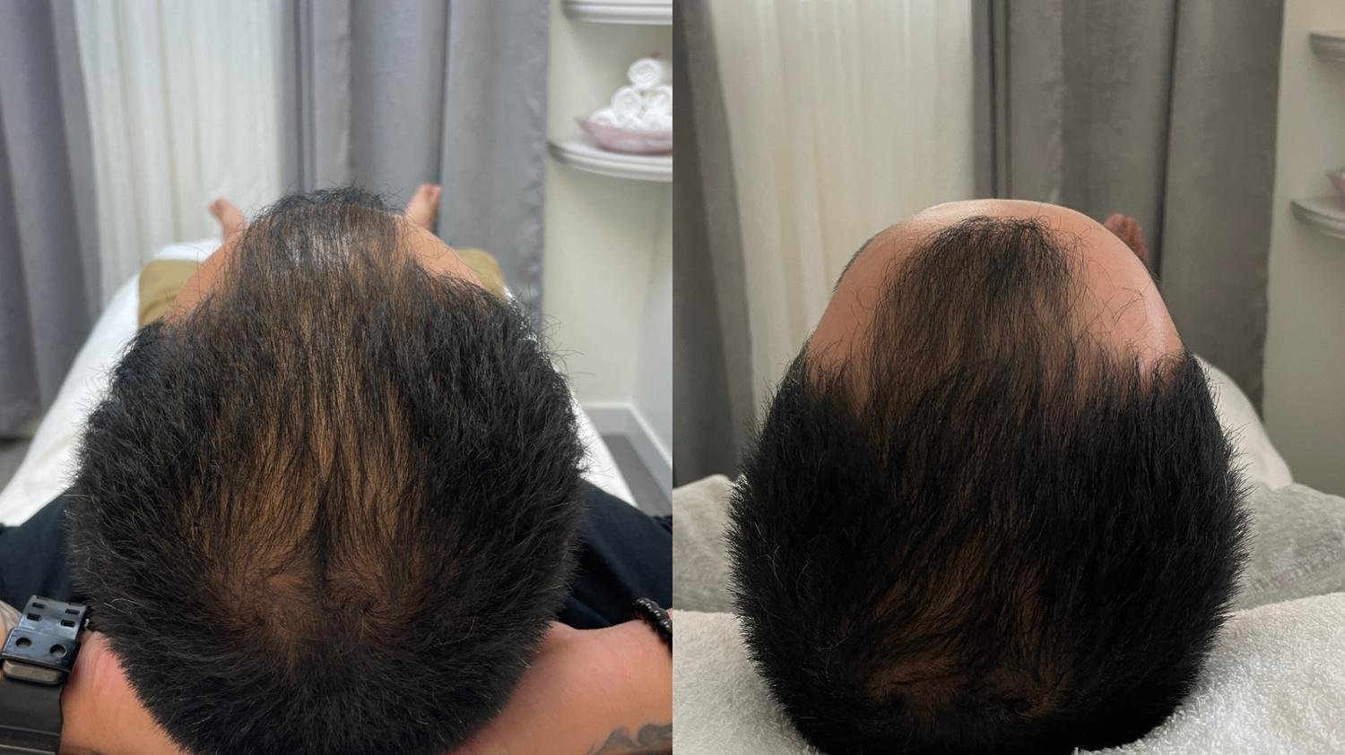 Procell Microchanneling at North Fork Rejuvenation Aesthetics