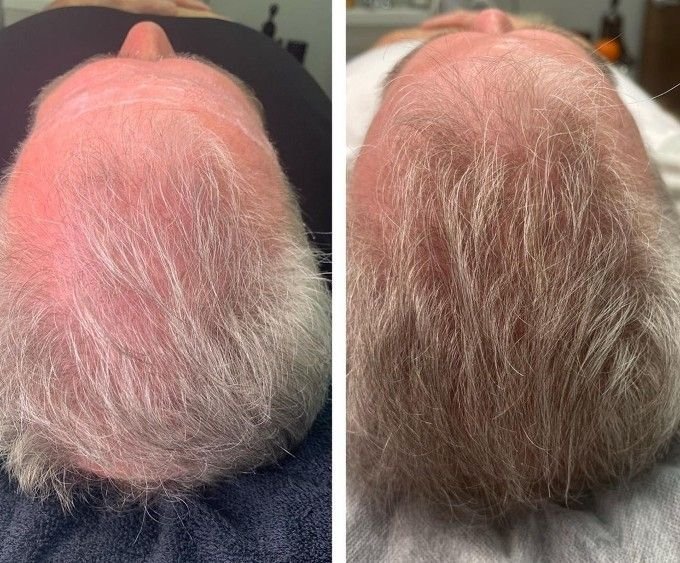 Procell Microchanneling at North Fork Rejuvenation Aesthetics
