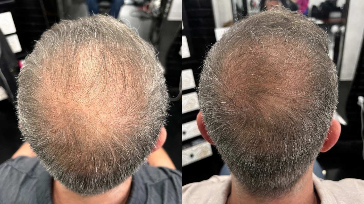 Procell Microchanneling at North Fork Rejuvenation Aesthetics